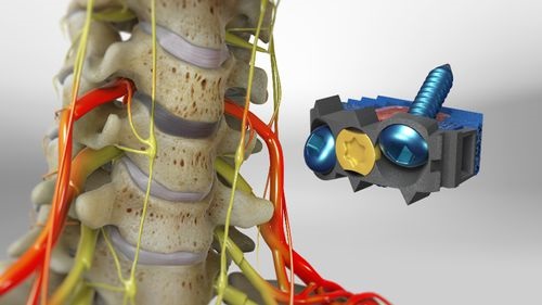 Anterior Cervical Discectomy and Fusion (ACDF), with Cage - Willis ...