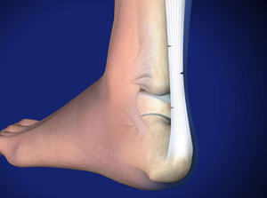 Achilles Tendon Lengthening - Willis Knighton Health - Shreveport ...
