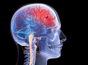 Coil Embolization for Brain Aneurysm - Willis Knighton Health ...