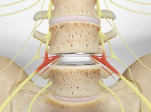 Artificial Disc Replacement (in the Lumbar Spine)