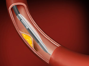 Atherectomy (Directional) - Willis Knighton Health - Shreveport ...