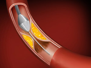 Atherectomy (Rotational) - Willis Knighton Health - Shreveport ...