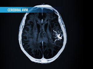 Resection of Cerebral Arteriovenous Malformation - Willis Knighton ...