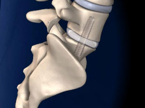 AxiaLIF® (Axial Lumbar Interbody Fusion)
