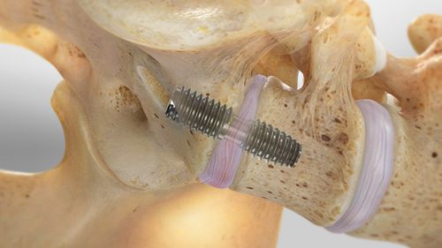 AxiaLIF (Axial Lumbar Interbody Fusion) AxiaLIF (Axial Lumbar Interbody ...