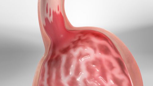 Barrett's Esophagus - Willis Knighton Health - Shreveport - Bossier ...