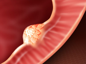 Bladder Cancer - Willis Knighton Health - Shreveport - Bossier City ...