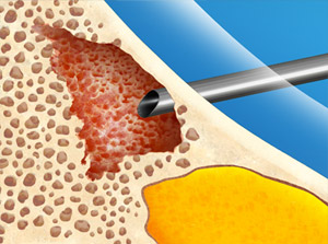 Bone Cement Injection - Willis Knighton Health - Shreveport - Bossier ...