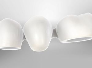 Dental Bridge (Fixed Partial Denture) - Willis Knighton Health ...