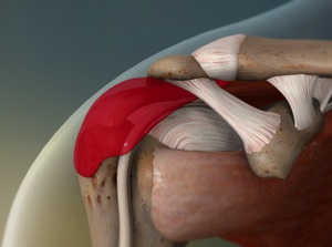 Bursitis of the Shoulder (Subacromial Bursitis) - Willis Knighton ...