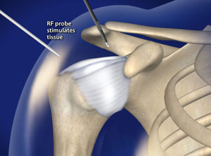 Arthroscopic Capsular Plication - Willis Knighton Health - Shreveport ...