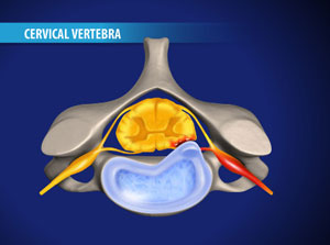Percutaneous Cervical Disc Nucleoplasty - Willis Knighton Health ...