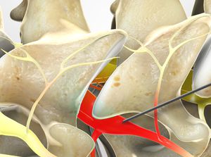 Selective Nerve Root Block (SNRB) in the Cervical Spine - Willis ...