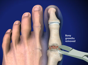 Hallux Rigidus Cheilectomy Implant Arthroplasty Versus Arthrodesis For