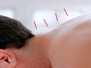 Chinese Acupuncture for Neck Pain - Willis Knighton Health - Shreveport ...