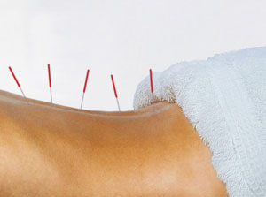 Chinese Acupuncture for Lower Back Pain - Willis Knighton Health ...