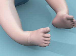 Clubfoot (Talipes Equinovarus) - Willis Knighton Health - Shreveport ...
