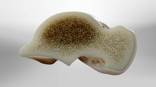 Core Decompression for Avascular Necrosis of the Talus - Willis ...