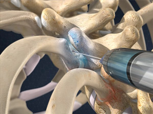 Costovertebral Joint Injection - Willis Knighton Health - Shreveport ...