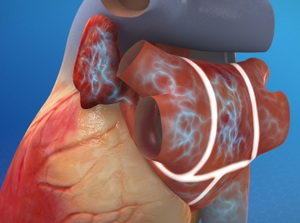 Cox-Maze Procedure for Atrial Fibrillation - Willis Knighton Health ...