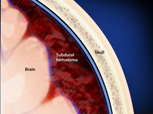 Craniotomy for Subdural Hematoma