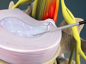 Percutaneous Disc Decompression (Stryker® Disc Dekompressor® Discectomy ...