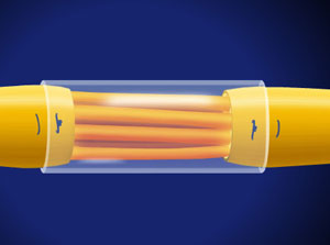 Digital Nerve Repair