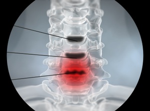 Discography (Cervical) - Willis Knighton Health - Shreveport - Bossier ...