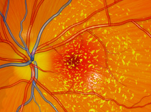 Age-Related Macular Degeneration, Dry Type (Dry AMD)
