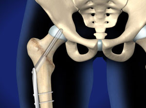 Femur Fracture Fixation with Dynamic Hip Screw - Willis Knighton Health ...