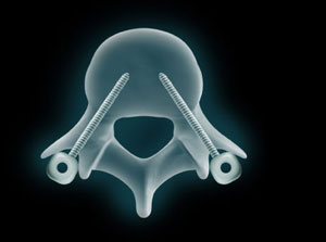 Spine Stabilization System (DYNESYS®)