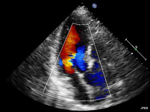 Echocardiogram