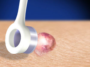 Electrodesiccation and Curettage (ED and C)