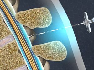 Epidural for Childbirth