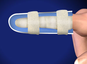 Finger Fracture Fixation