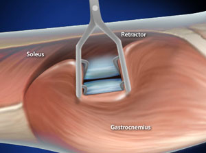 Gastrocnemius Recession (Intramuscular Approach) - Willis Knighton ...