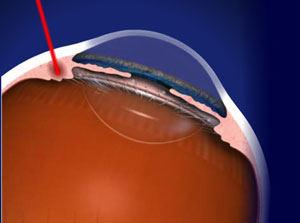 Glaucoma Laser Treatment: CPC - Willis Knighton Health - Shreveport ...