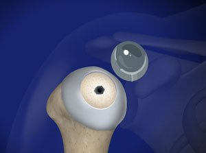 HemiCap® Resurfacing - Willis-Knighton Health System