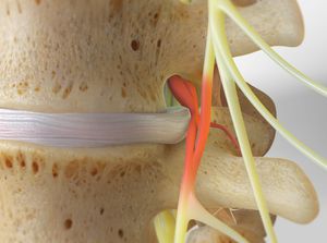 Herniated Disc - Willis Knighton Health - Shreveport - Bossier City ...