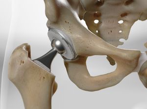 Total Hip Replacement, Anterior Approach (Accolade® II) - Willis ...