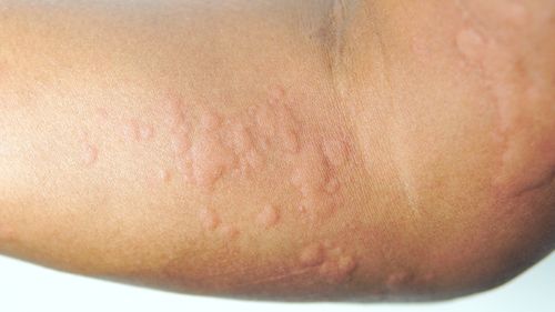 Hives - Willis Knighton Health - Shreveport - Bossier City - Ark-La-Tex