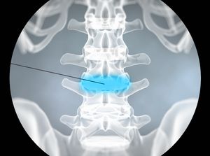 Intradiscal Injection - Willis Knighton Health - Shreveport - Bossier ...