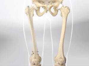 Femur Fracture Fixation with Intramedullary Rod