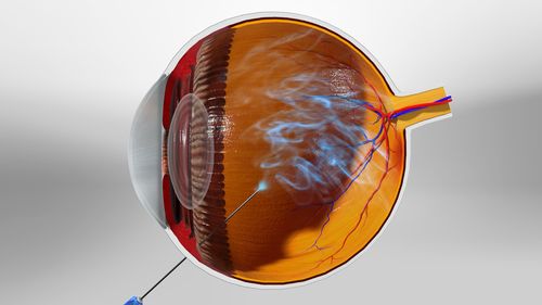 Intravitreal Injection - Willis Knighton Health - Shreveport - Bossier ...