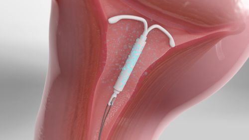 Hormonal IUD (Intrauterine Device) - Willis Knighton Health ...