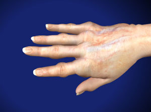 Joint Synovectomy - Willis Knighton Health - Shreveport - Bossier City ...