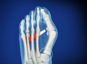 Lapidus Procedure for Bunion Correction