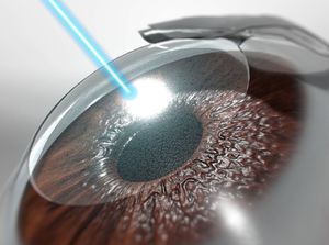 LASIK Eye Surgery (CustomVue Laser System) - Willis Knighton Health ...