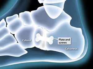 Lateral Column Lengthening (Evans Osteotomy) for Adult Acquired Flatfoot