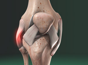 Lateral Collateral Ligament (LCL) Injury - Willis Knighton Health ...